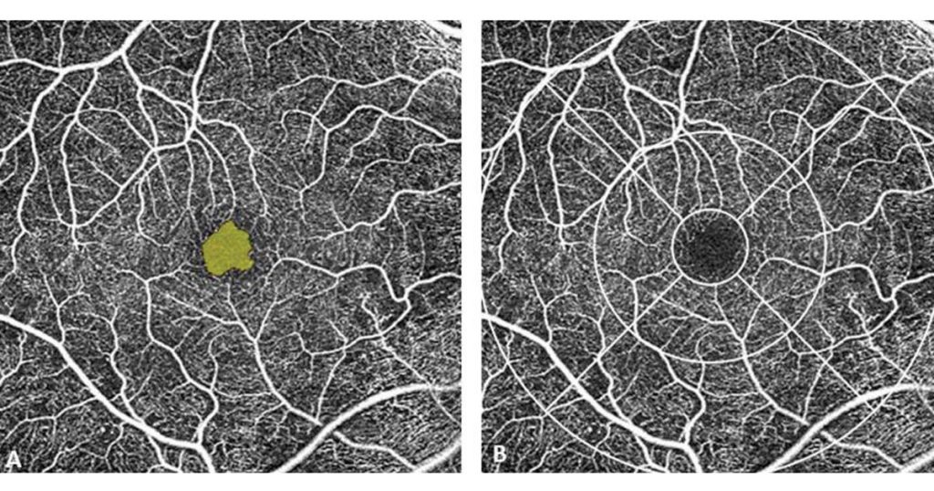 OCT angiography can evaluate tuberculous uveitis - eMedNews