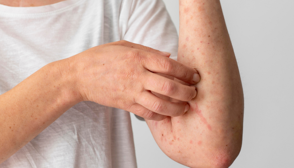 New Anaphylaxis & Atopic Dermatitis Guidelines - eMedNews