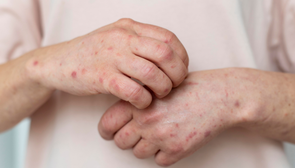 FDA Approves Berdazimer Gel: Breakthrough for Molluscum Contagiosum ...