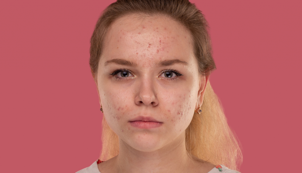 Antioxidants: Impact on Quality of Life in Acne Vulgaris - eMedNews